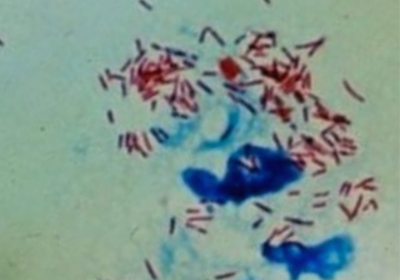 Treatment - Sasakawa Leprosy (Hansen’s Disease) Initiative